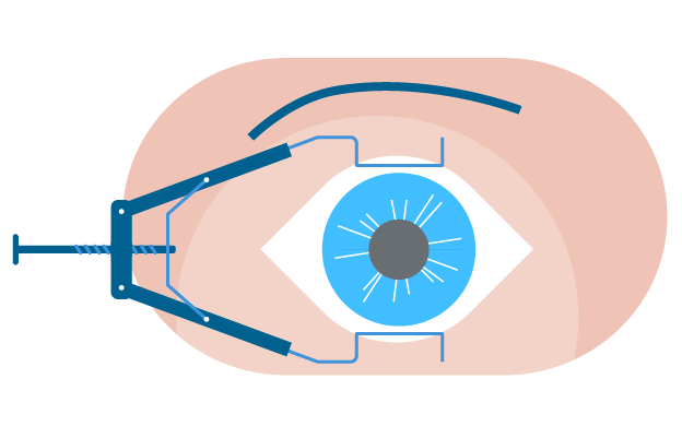 The Truth About Strabismus Surgery For Misaligned Eyes Crossed Eyes Or Wall Eyes 2023 Update